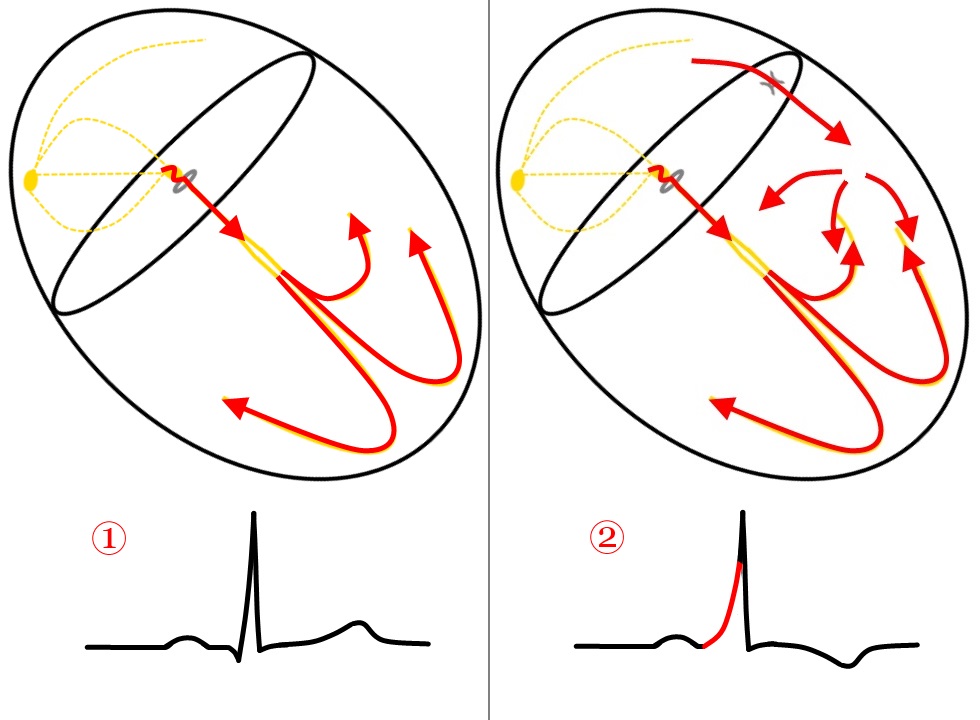 Accessory Pathway Conduction Illustration Ecg Guru Instructor Resources